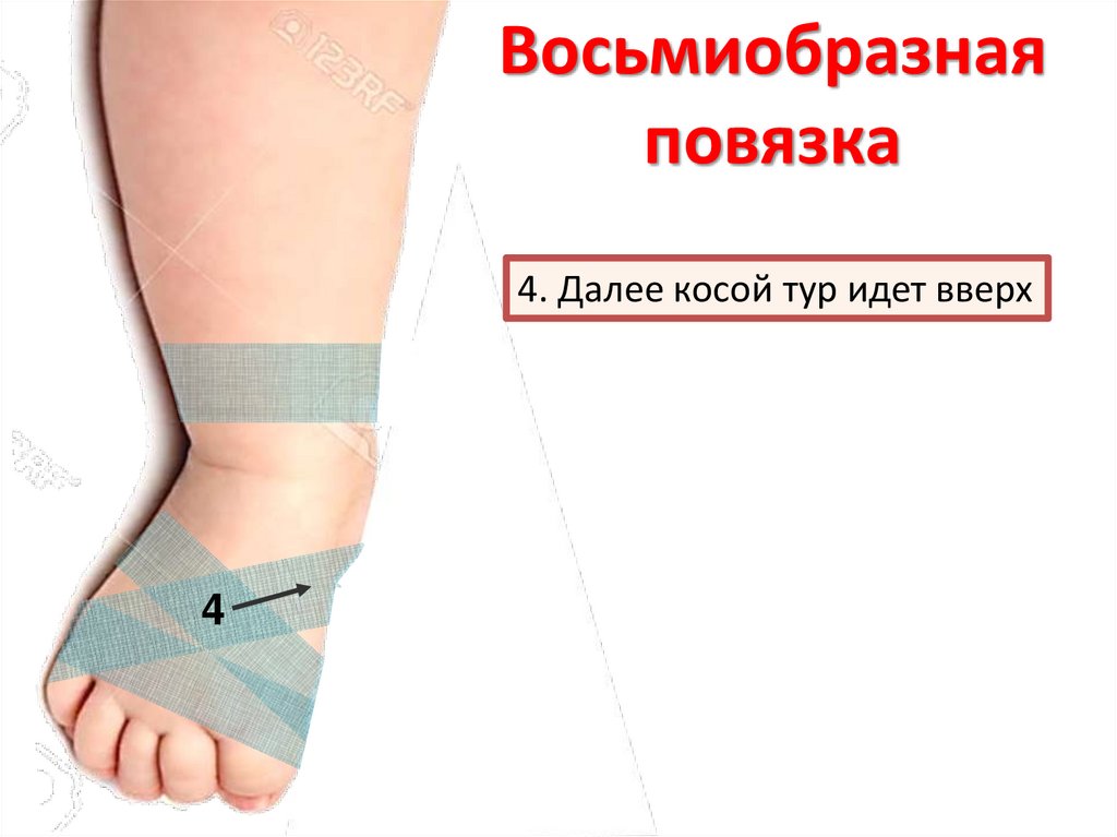Отработка приемов по наложению крестообразной (восьмиобразной) повязки ...