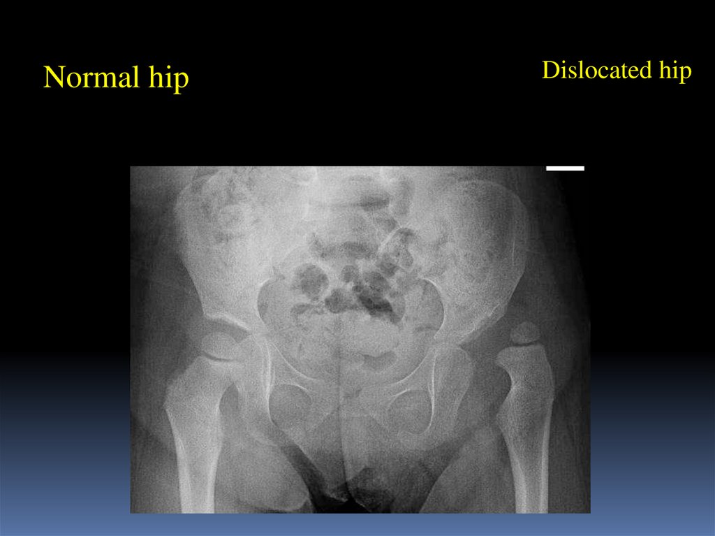 Congenital dislocation of the hip - online presentation